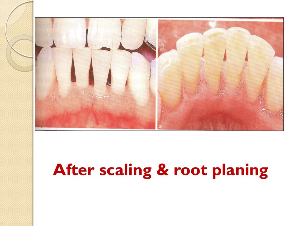 Principles of scaling & root planing dr alaa attia Principles of scaling & root planing dr alaa attia