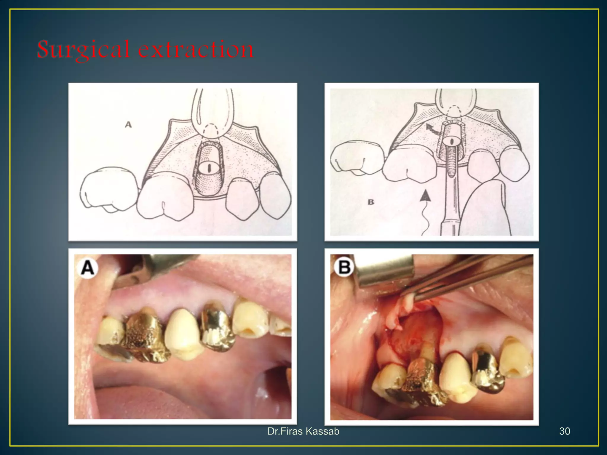 Principles of simple extractions 1 | PDF