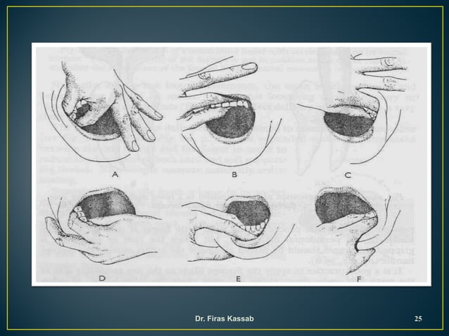 Principles of simple extractions 2 | PDF | Dental Health | Diseases and ...