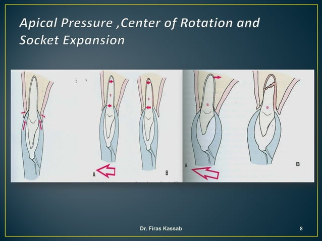 Principles of simple extractions 2 | PDF | Dental Health | Diseases and ...