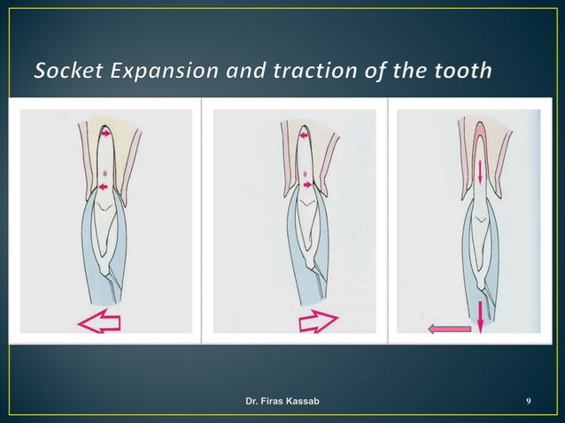 Principles of simple extractions 2 | PDF | Dental Health | Diseases and ...