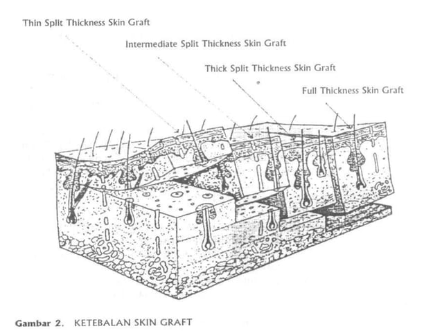 PRINCIPLES of SKIN GRAFT and FLAP.ppt | First Aid | Injuries