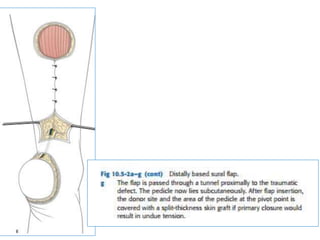 PRINCIPLES of SKIN GRAFT and FLAP.ppt