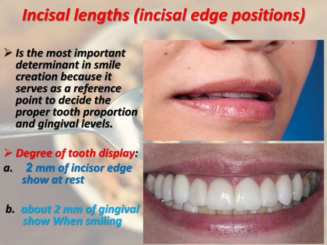 Principles of smile design | PPTX | Dental Health | Diseases and Conditions