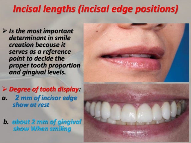 Principles of smile design