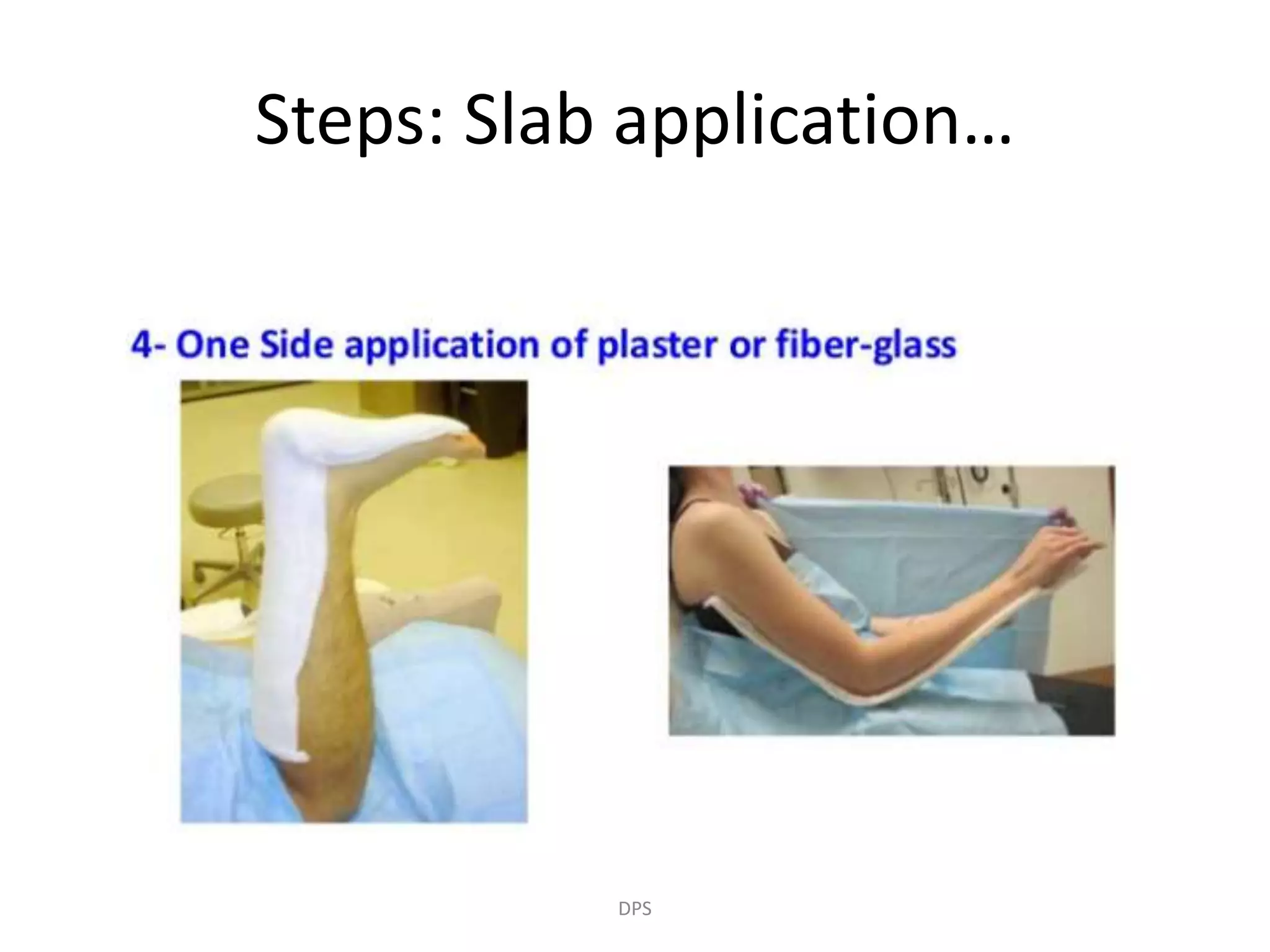 Principles of splints and casts in orthopaedics by Dr. D. P. Swami | PPTX