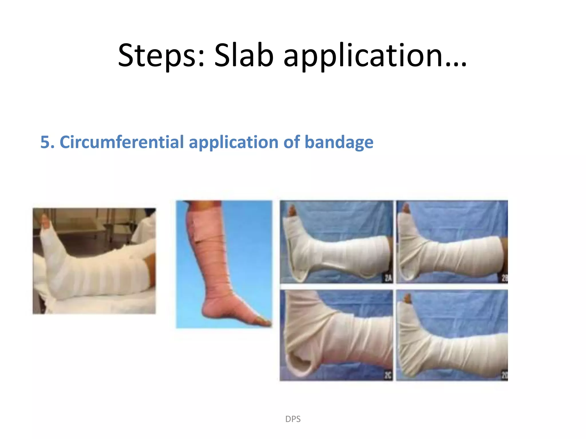 Principles of splints and casts in orthopaedics by Dr. D. P. Swami | PPTX