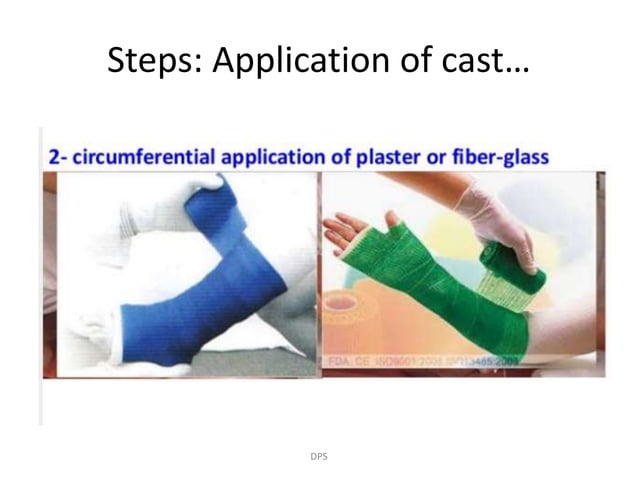 Principles of splints and casts in orthopaedics by Dr. D. P. Swami | PPTX