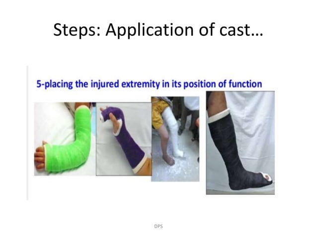 Principles of splints and casts in orthopaedics by Dr. D. P. Swami | PPT