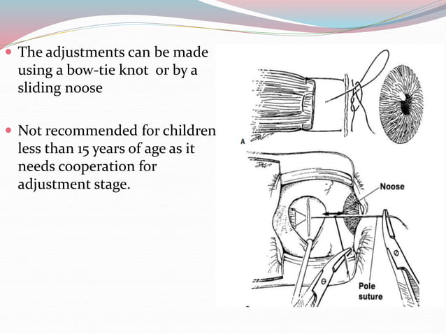 Principles of strabismus surgery | PPTX