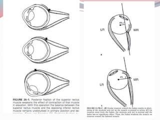 Principles of strabismus surgery | PPTX