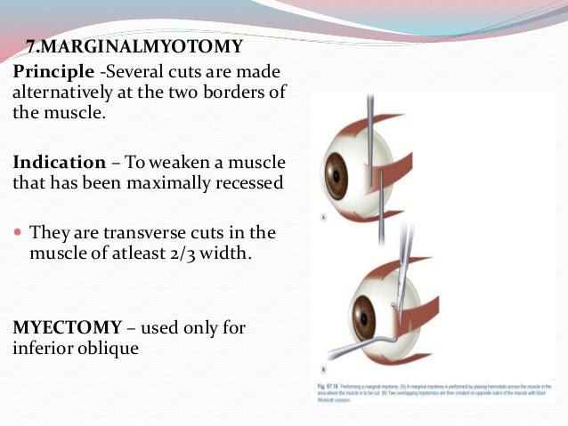 Principles of strabismus surgery