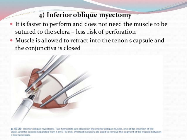 Principles of strabismus surgery