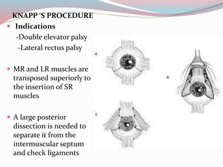 Principles of strabismus surgery | PPTX