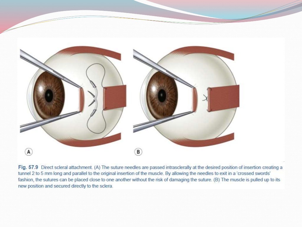 Principles of strabismus surgery