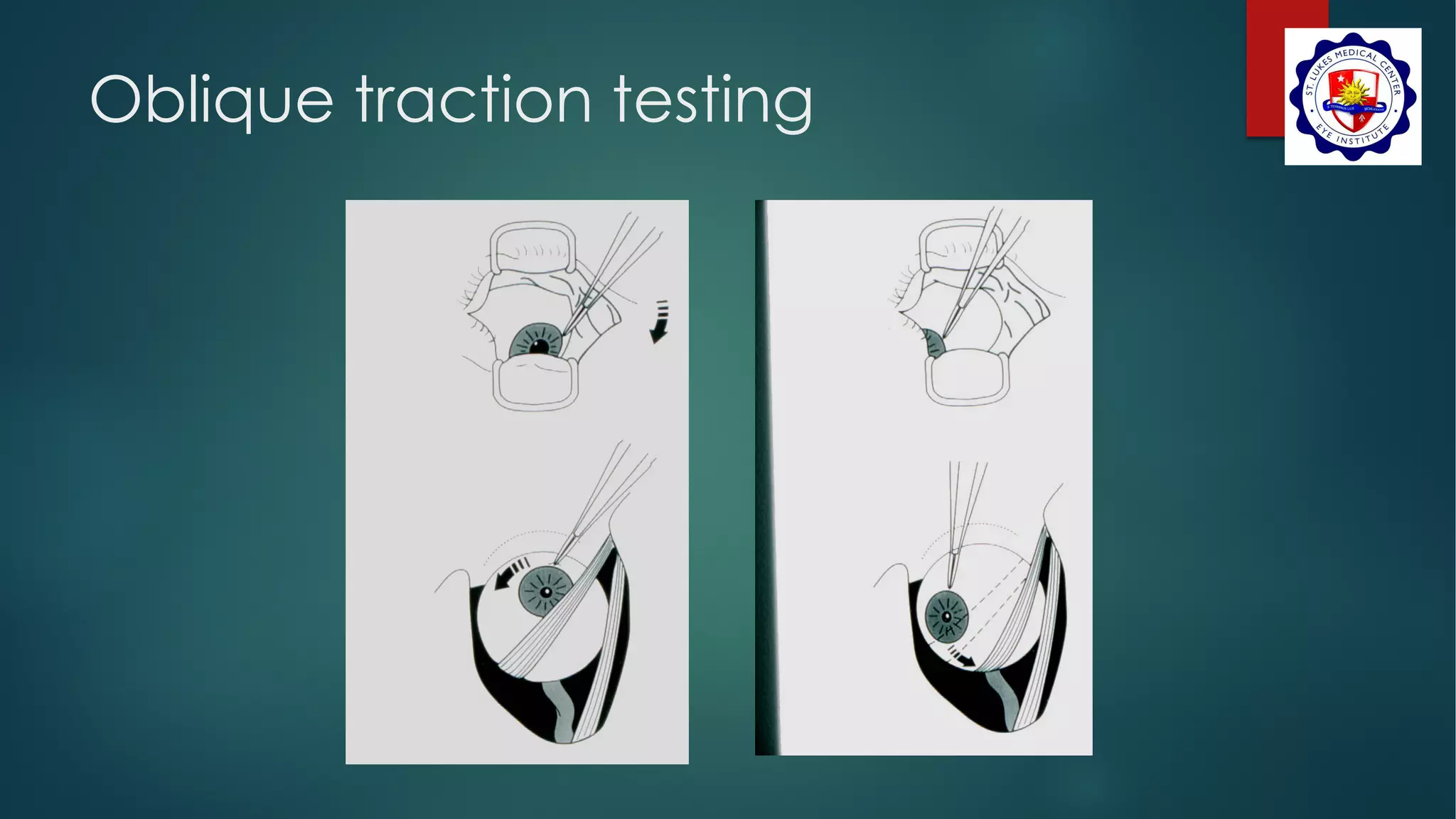 Principles of strabismus surgery part 2 of 3 | PDF