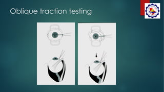 Principles of strabismus surgery part 2 of 3 | PDF