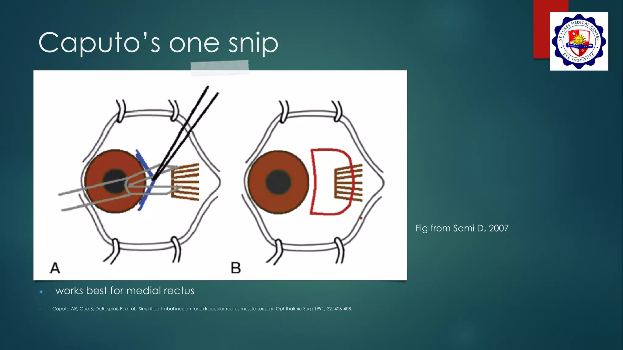 Principles of strabismus surgery part 3 of 3 | PDF
