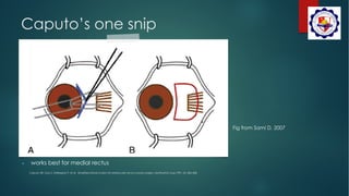 Principles of strabismus surgery part 3 of 3 | PDF | Eye and Vision ...
