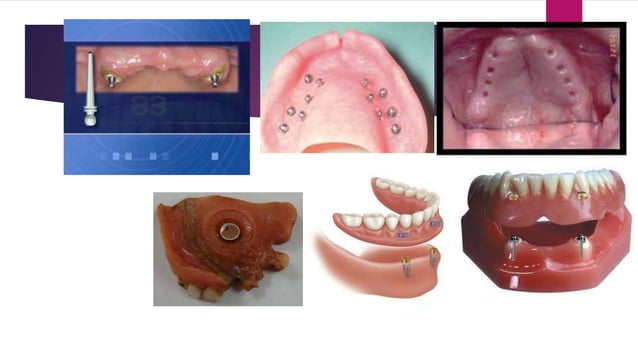 Principles of support stability and retention in complete dentures | PPT