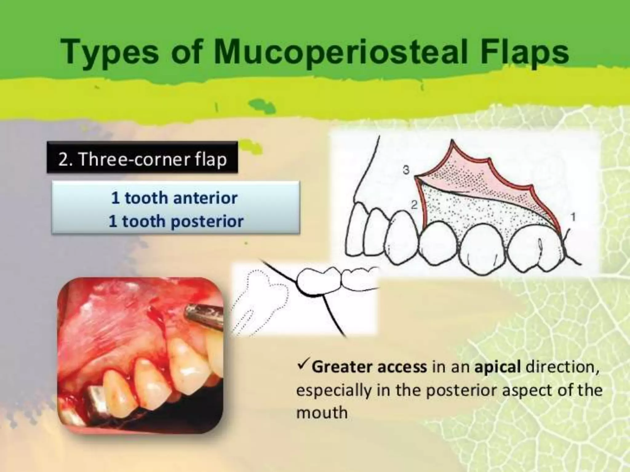 Principles of suture and flap design | PPTX