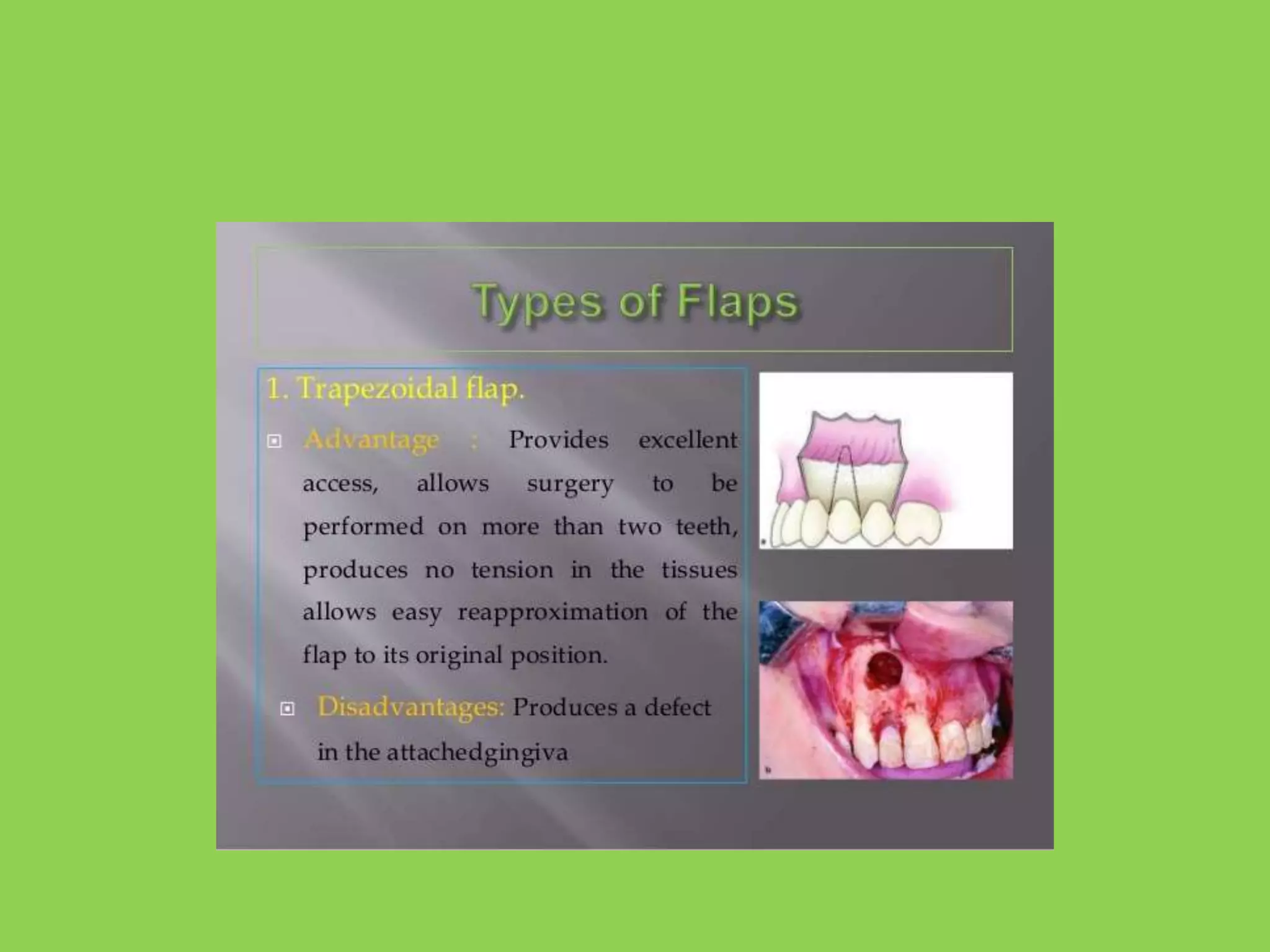 Principles of suture and flap design | PPTX
