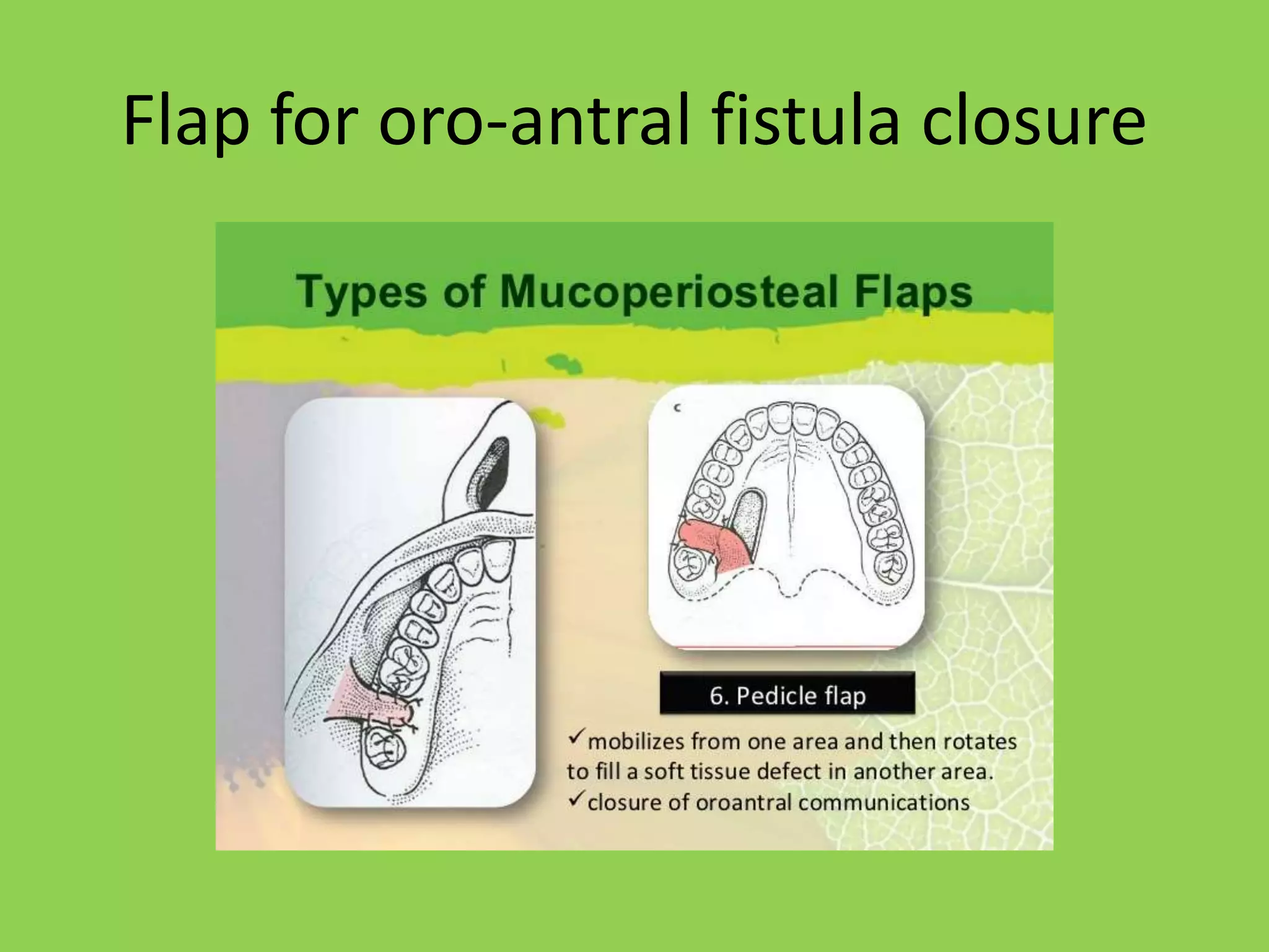 Principles of suture and flap design | PPTX
