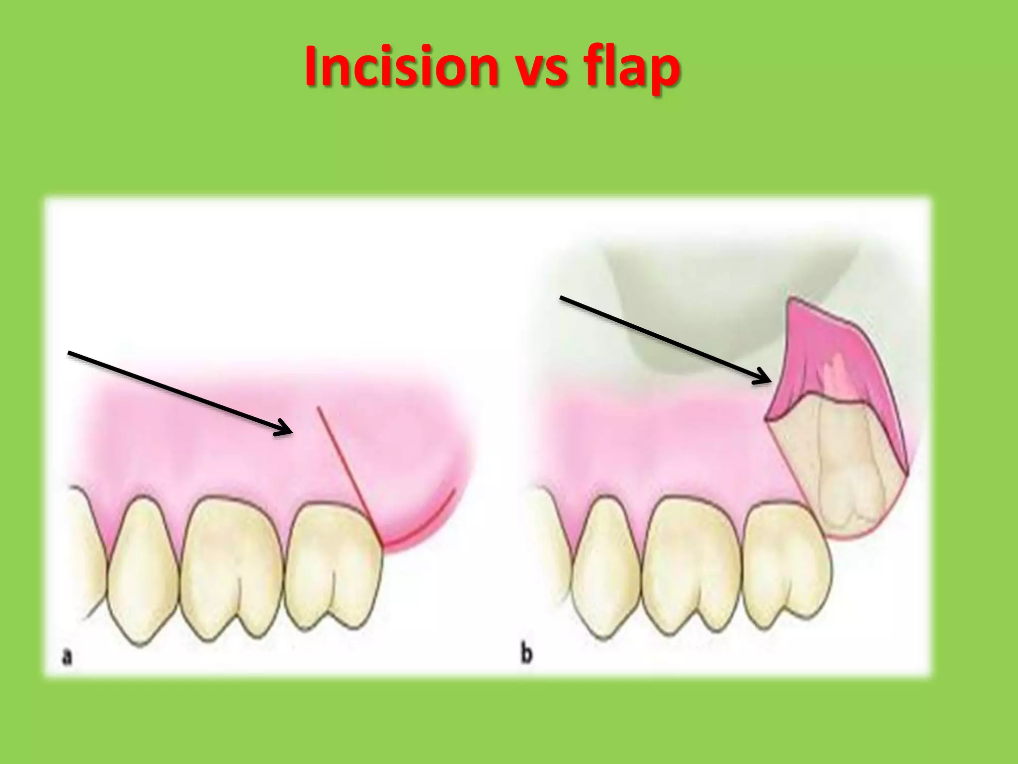 Principles of suture and flap design | PPTX