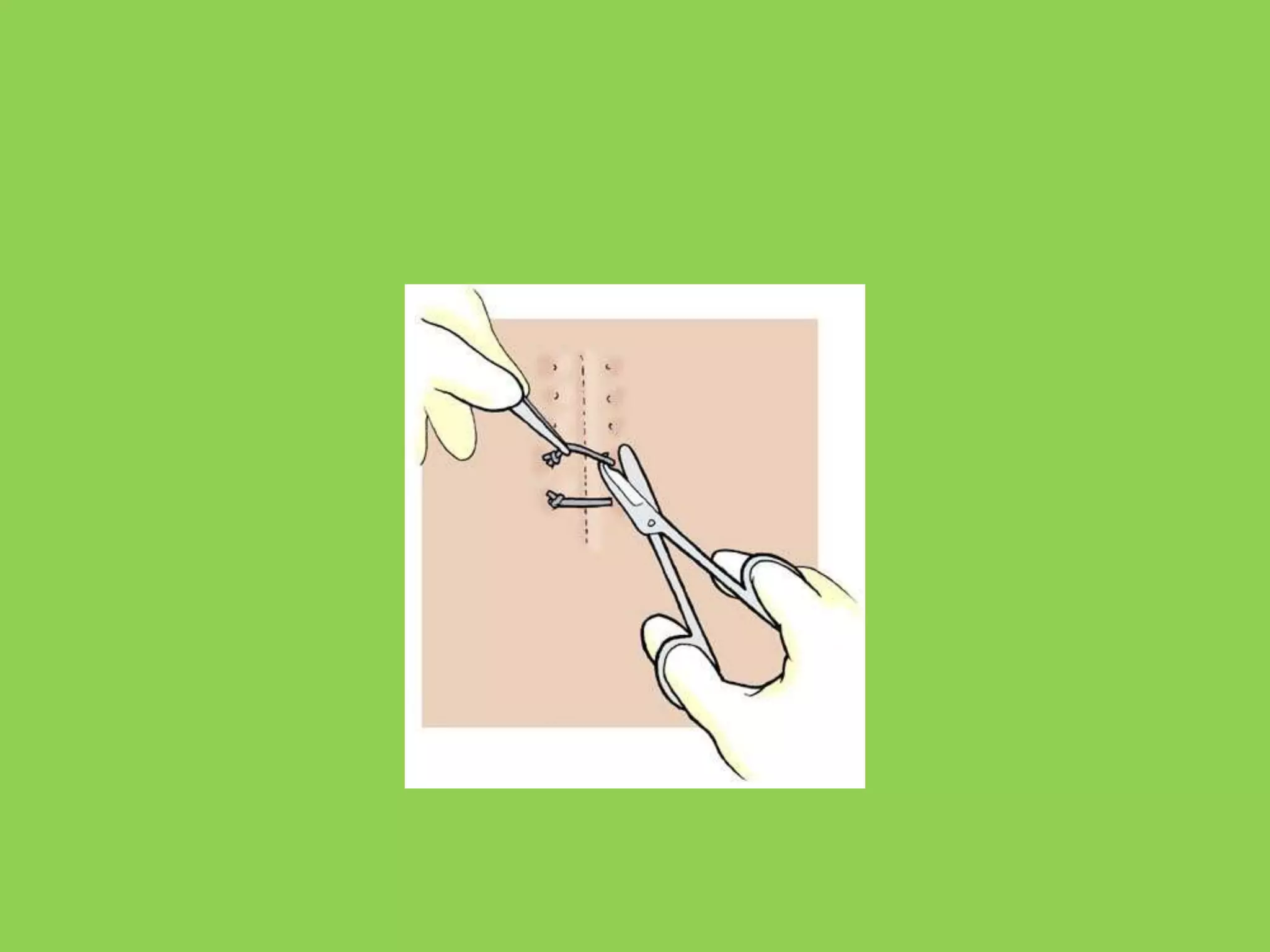 Principles of suture and flap design | PPTX