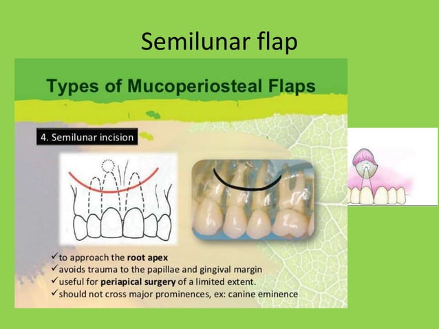 Principles of suture and flap design | PPTX