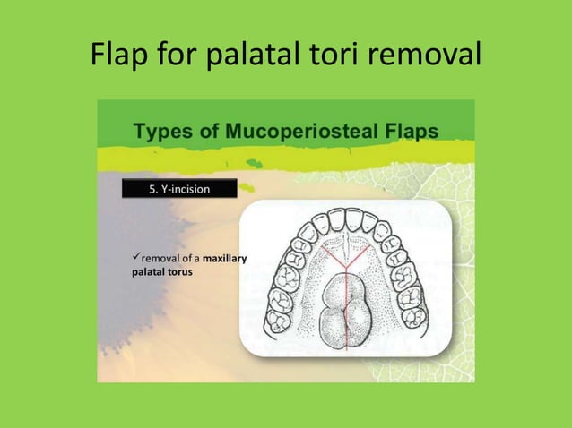 Principles of suture and flap design | PPTX