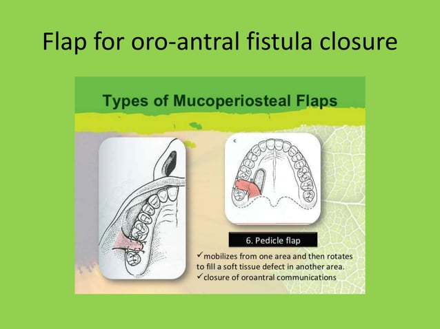 Principles of suture and flap design | PPTX