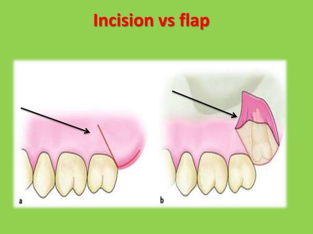 Principles of suture and flap design | PPTX