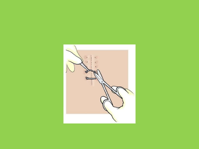 Principles of suture and flap design | PPTX