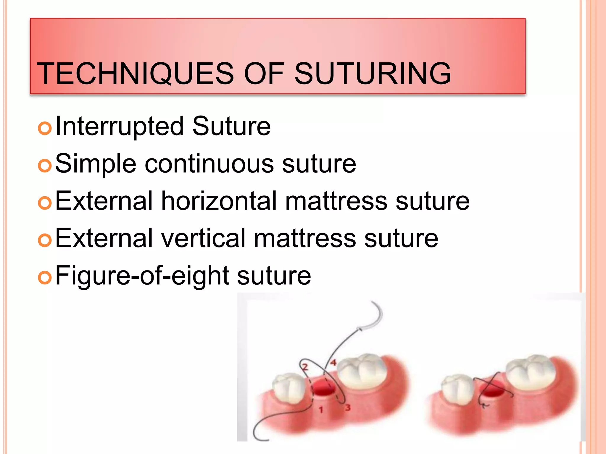 Principles of suturing in surgery | PPTX