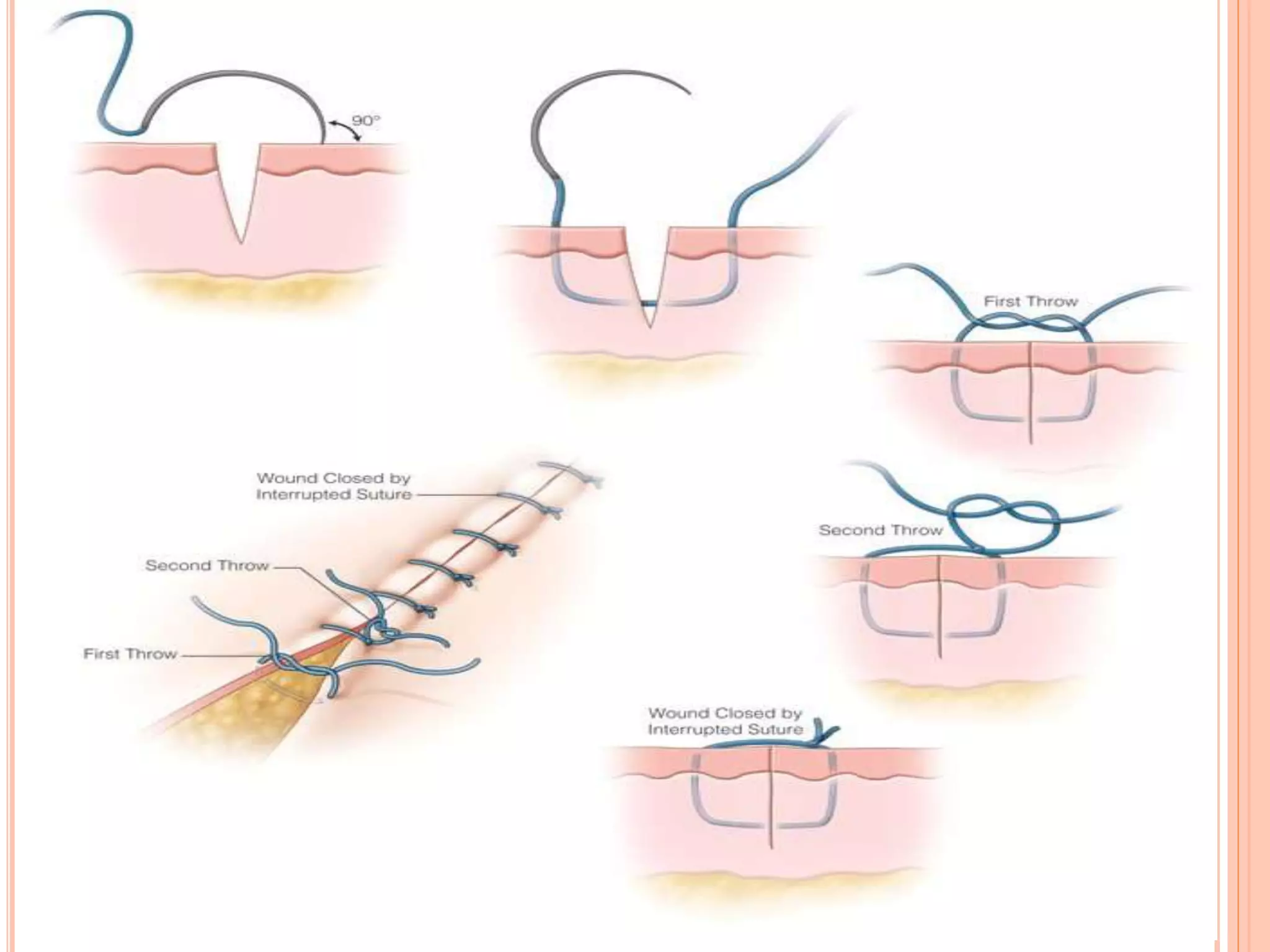 Principles of suturing in surgery | PPTX