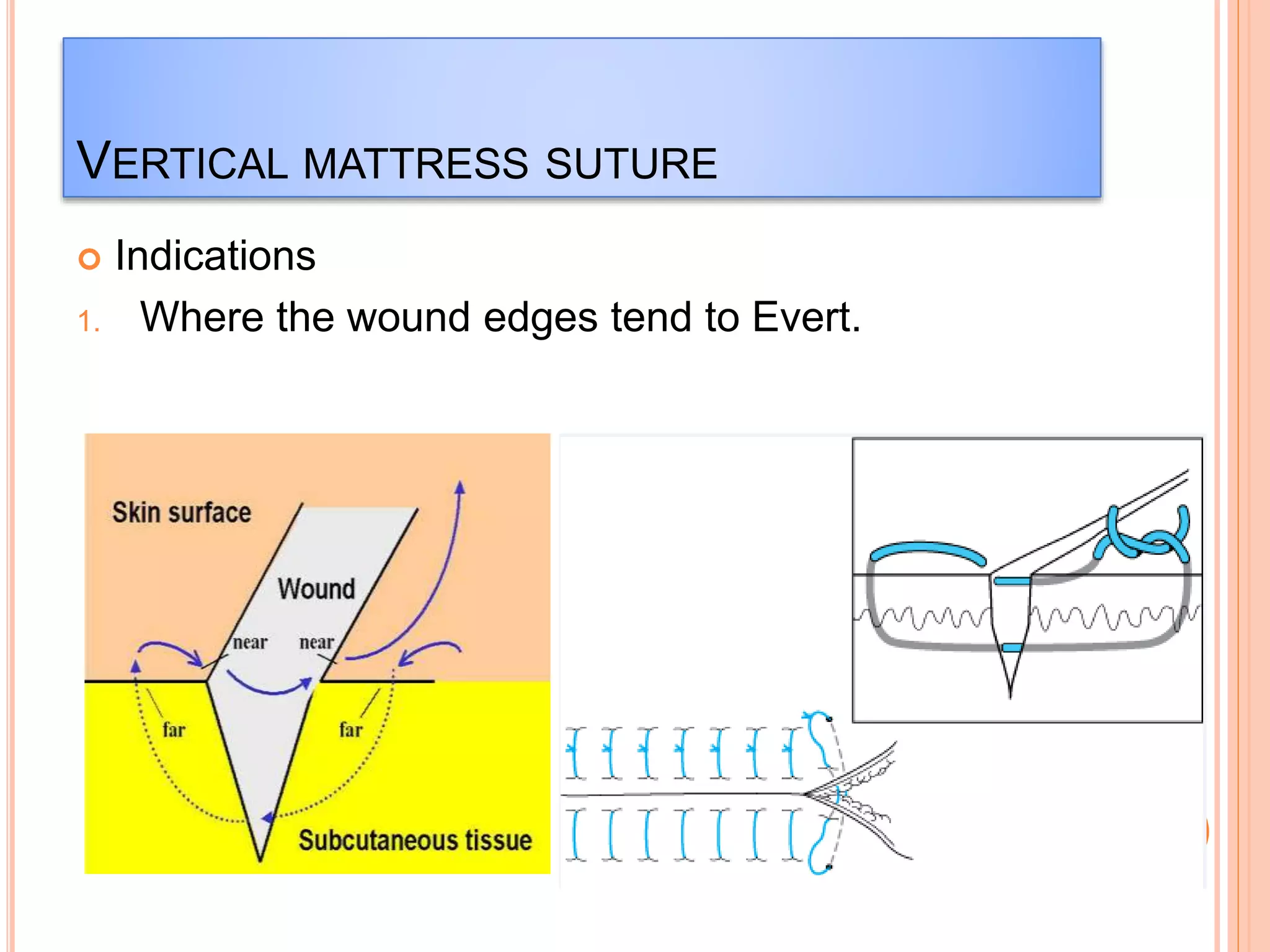 Principles of suturing in surgery | PPTX