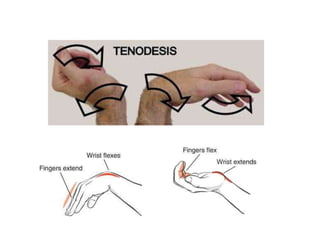 Principles of tendon transfer | PPTX