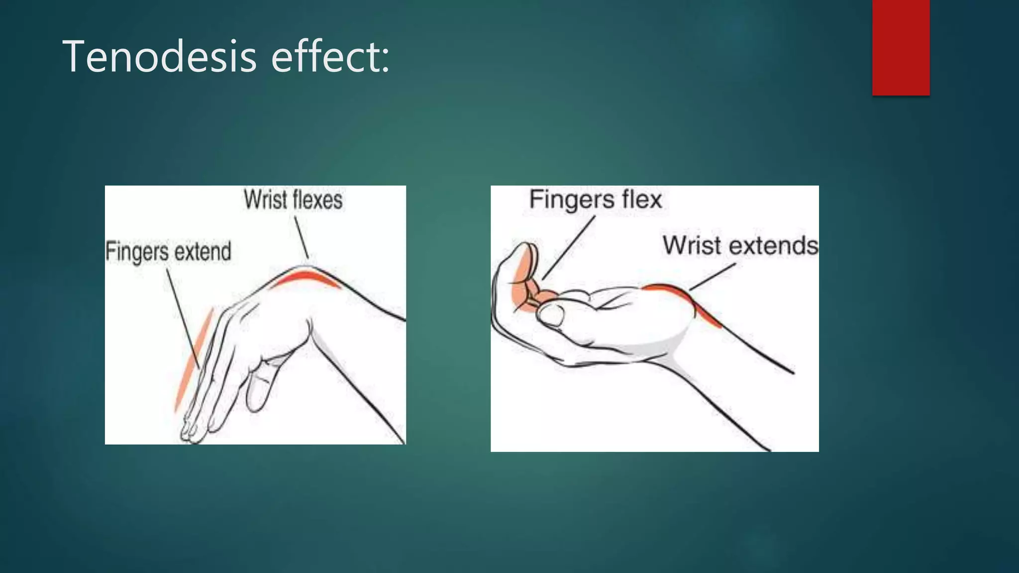 PRINCIPLES OF TENDON TRANSFERS | PPTX