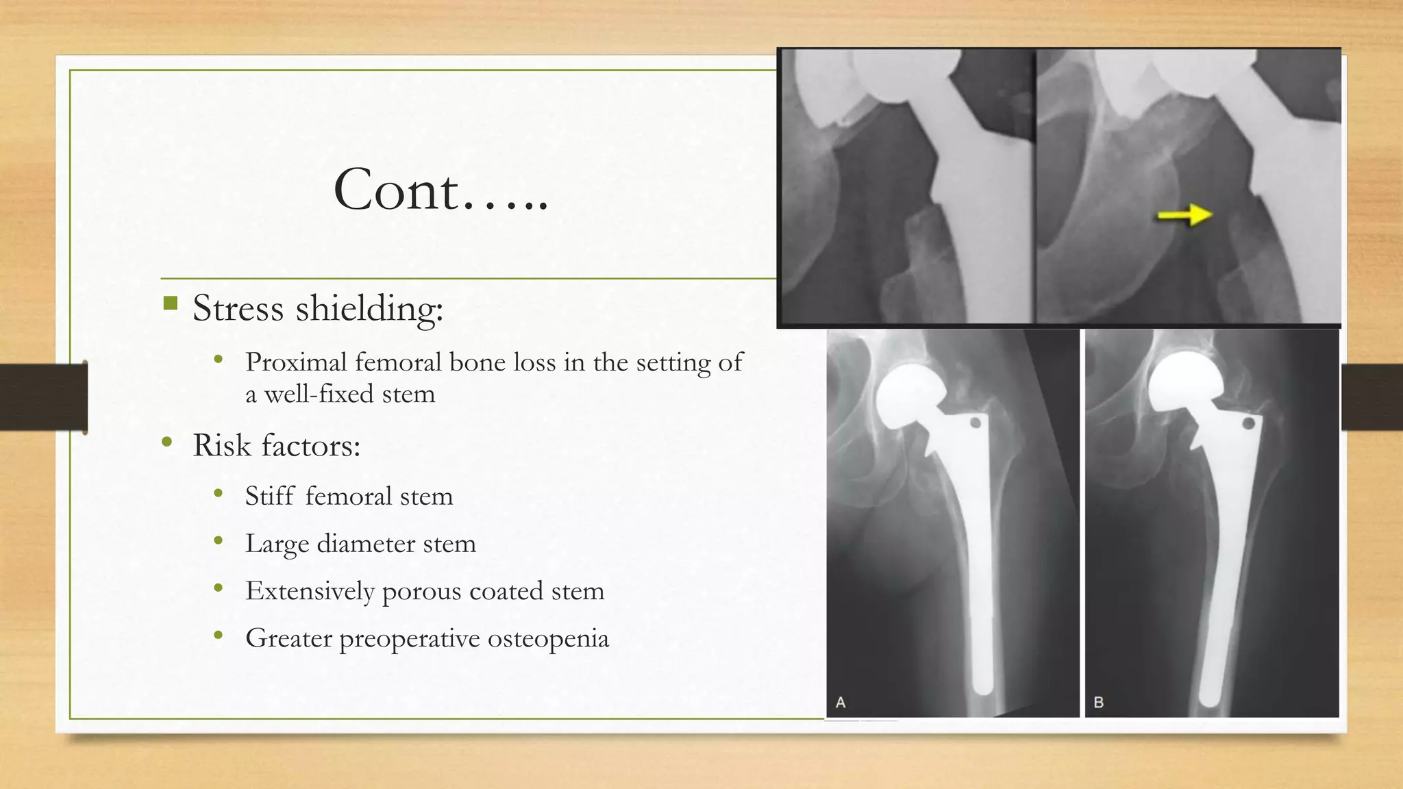 Principles Of Total Hip Replacement | PPTX