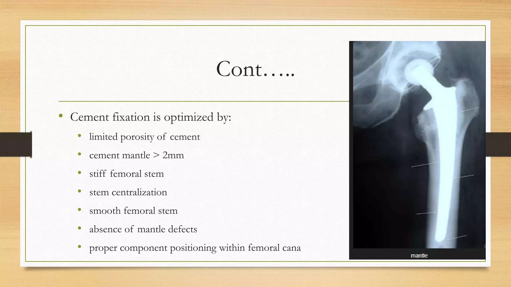 Principles Of Total Hip Replacement | PPTX