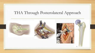 Principles Of Total Hip Replacement | PPTX