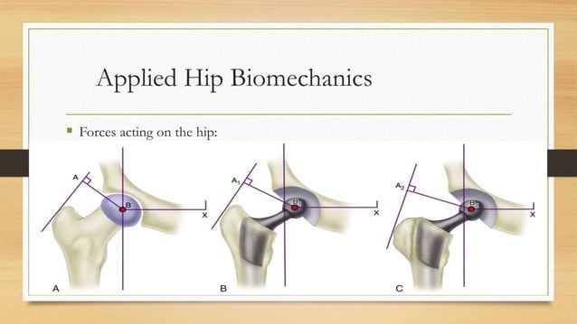 Principles Of Total Hip Replacement | PPTX