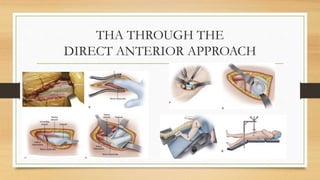 Principles Of Total Hip Replacement | PPTX