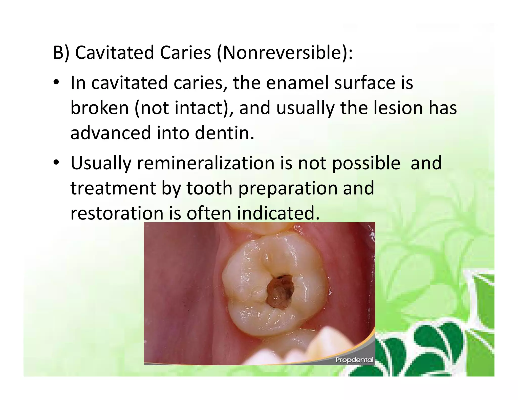 Principles of tooth preparation | PPT