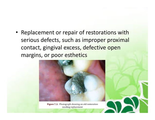 Principles of tooth preparation | PPT