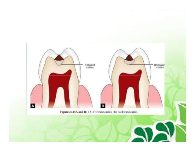 Principles of tooth preparation | PPT