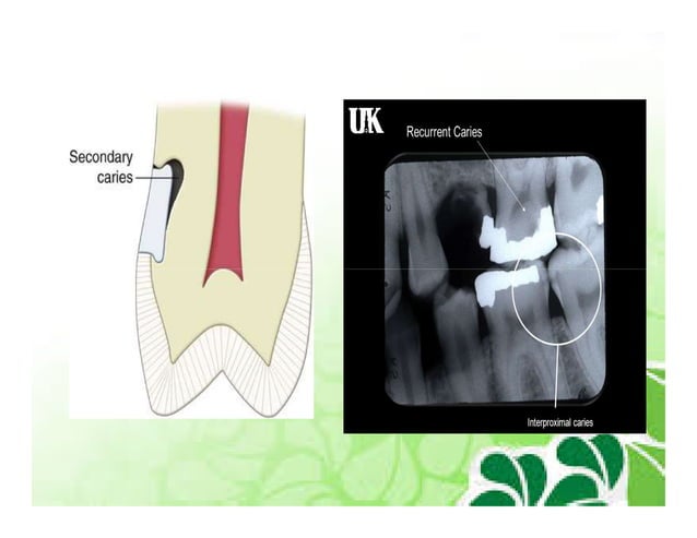 Principles of tooth preparation | PPT