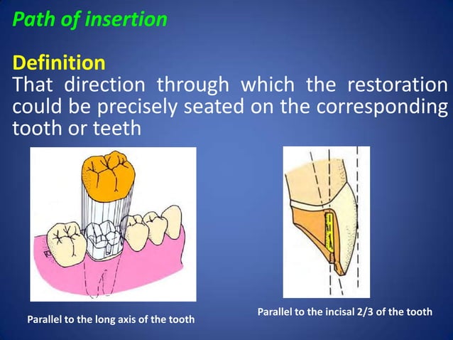 Principles of tooth preparation fixed orthodontic | PPTX | Dental ...