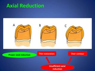 Principles of tooth preparation fixed orthodontic | PPTX